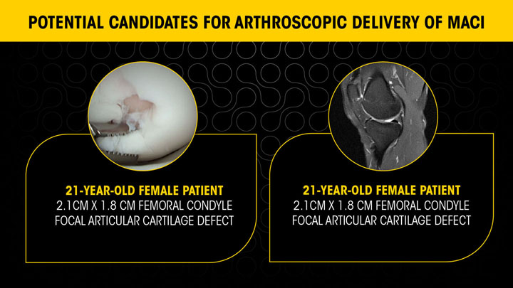 MACI Arthro Instrumentation: An Exciting Development in Arthroscopic Knee Cartilage Repair