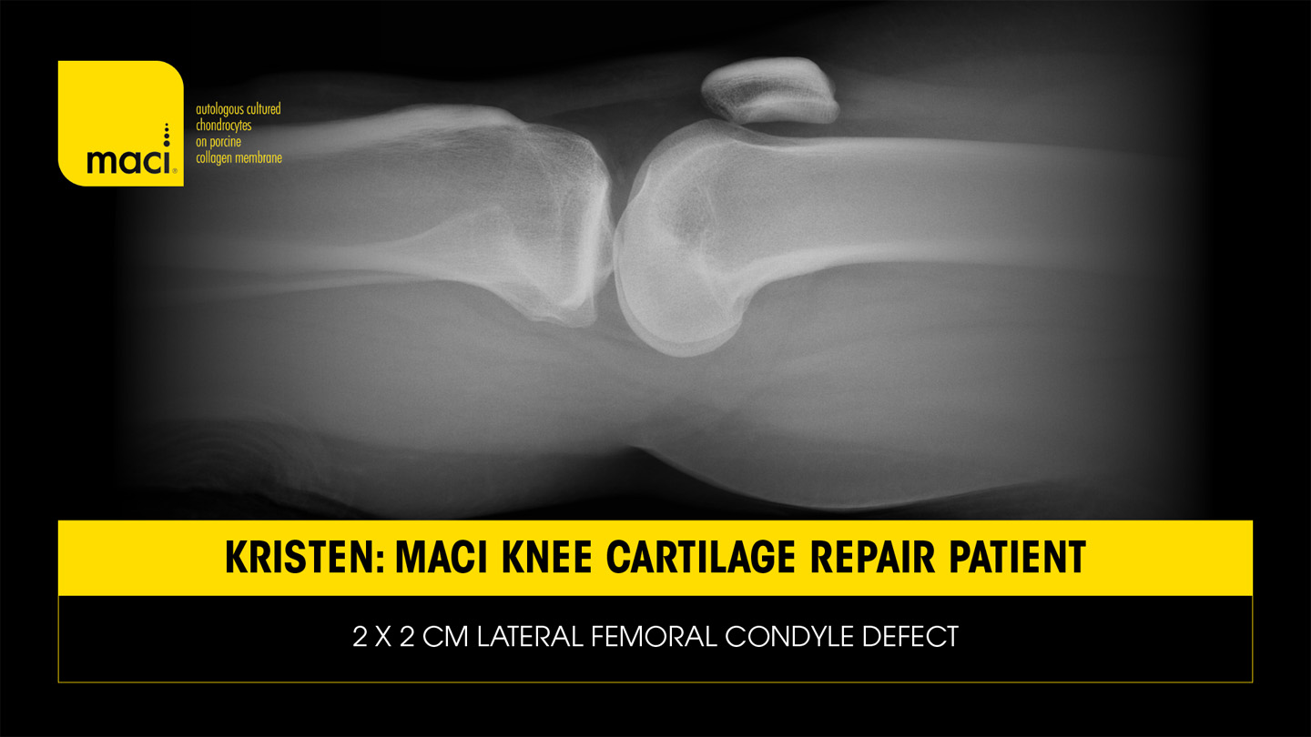 MACI Arthro Case: Exploring MACI Knee Cartilage Repair via Arthroscopic ...