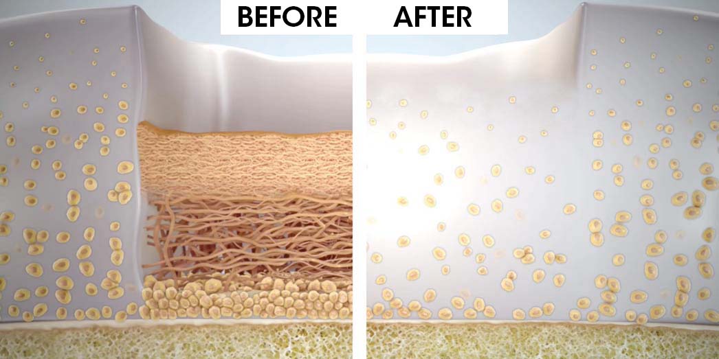 MACI vs. ACI: How the Third Generation ACI Repairs Knee Cartilage